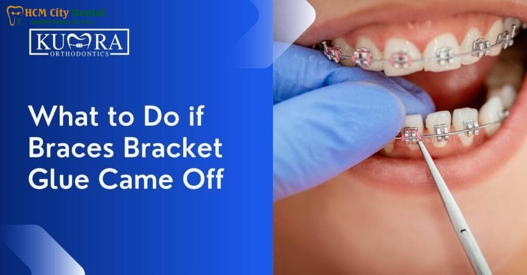 Braces Bracket Fell Off? Your 3-Step Solution! | Dr. Cuong - Ho Chi ...