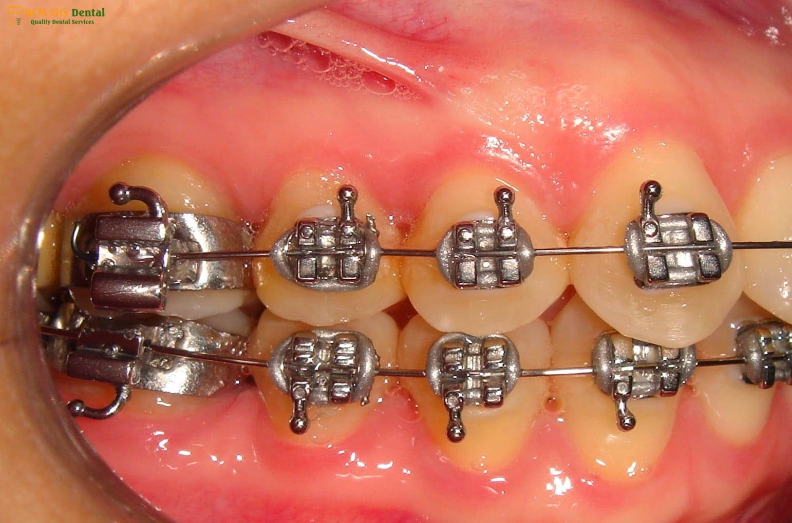 Braces Bracket Fell Off? Your 3-Step Solution! | Dr. Cuong - Ho Chi ...