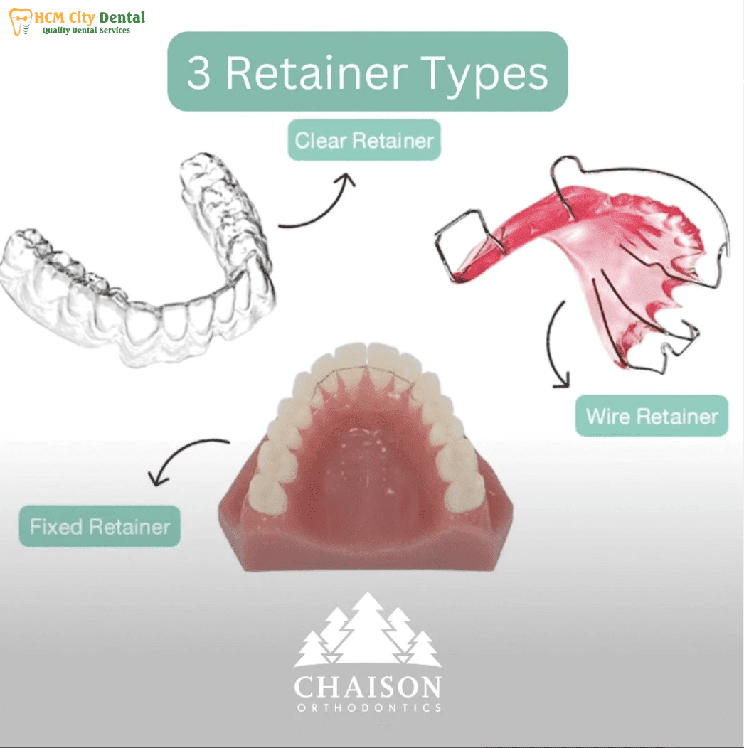 5 Braces Retainer Types: Find Your Perfect Fit | Dr. Cuong - Ho Chi ...