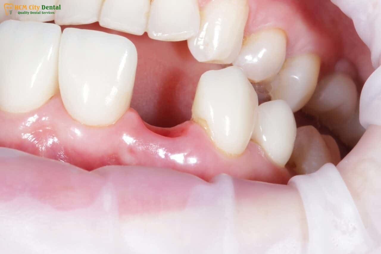 Can Teeth Regrow? The [Secrets] to Dental Regeneration | Dr. Cuong - Ho ...