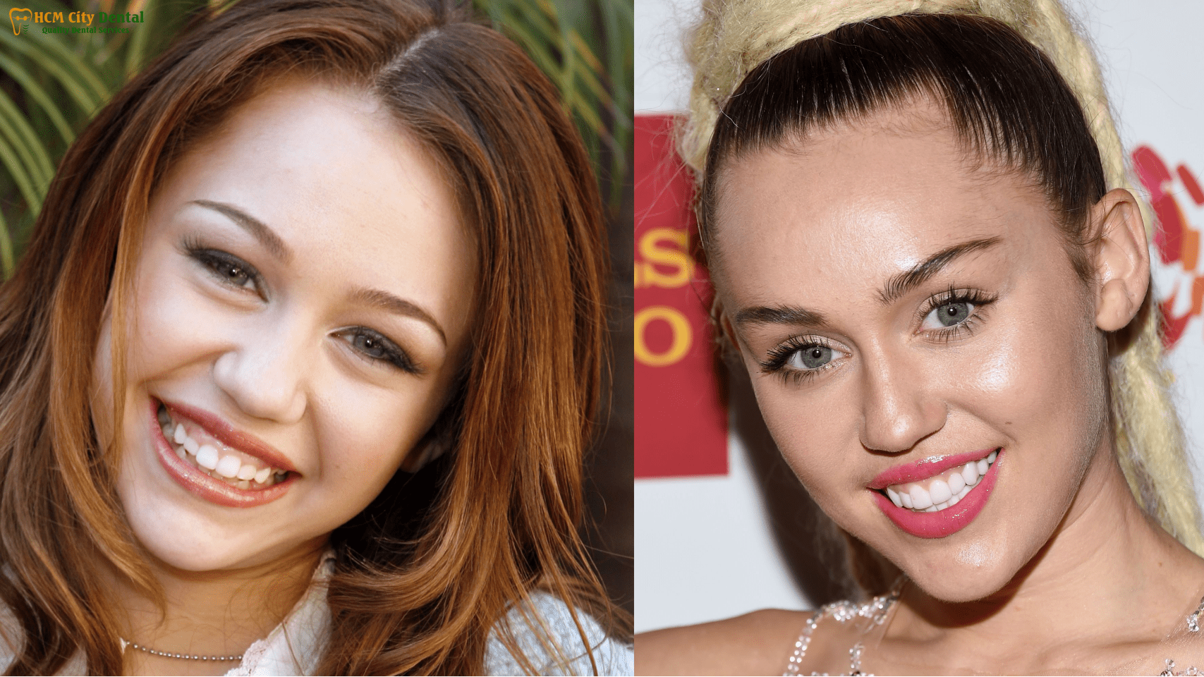 Celebrity Teeth Before & After [Dental Secrets] | Dr. Cuong - Ho Chi ...