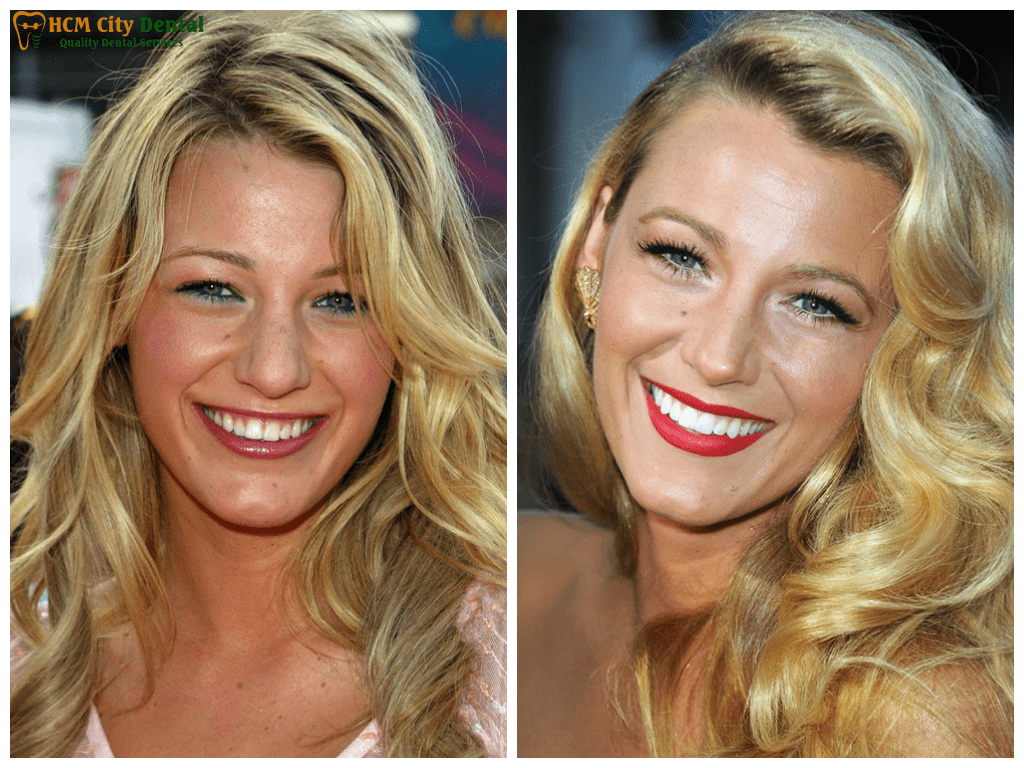 Celebrity Teeth Before & After [Dental Secrets] | Dr. Cuong - Ho Chi ...