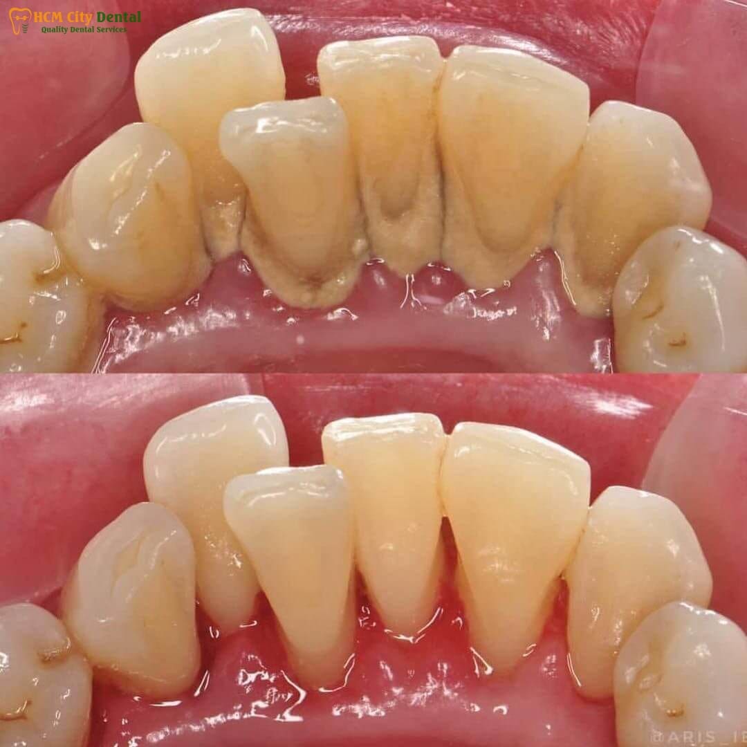 Dental Scaling: Is It Painful? Benefits & Costs | Dr. Cuong - Ho Chi ...
