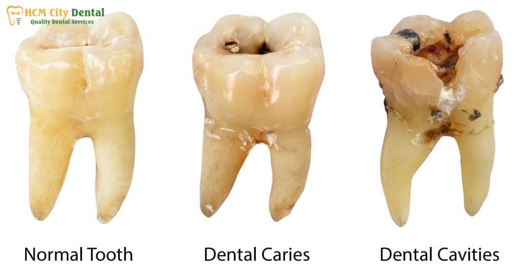 Effects of Sugar on Teeth: Stop Damage & Keep Your Smile | Dr. Cuong ...