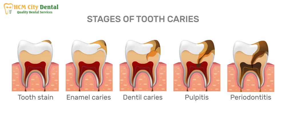 Can You Fix Tooth Enamel? [Real Solutions Inside] | Dr. Cuong - Ho Chi ...