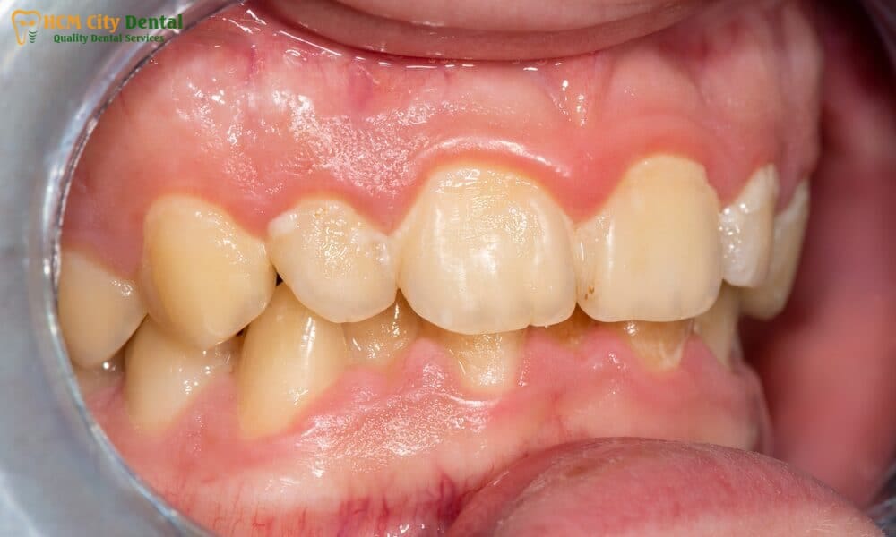 Gum Swelling Relief: 7 Proven Tips for Immediate Comfort | Dr. Cuong ...