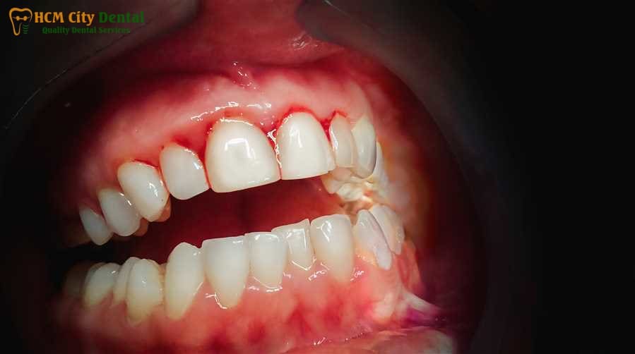 Gums Bleed When Brushing Teeth? Discover Top Solutions [Guide] | Dr ...