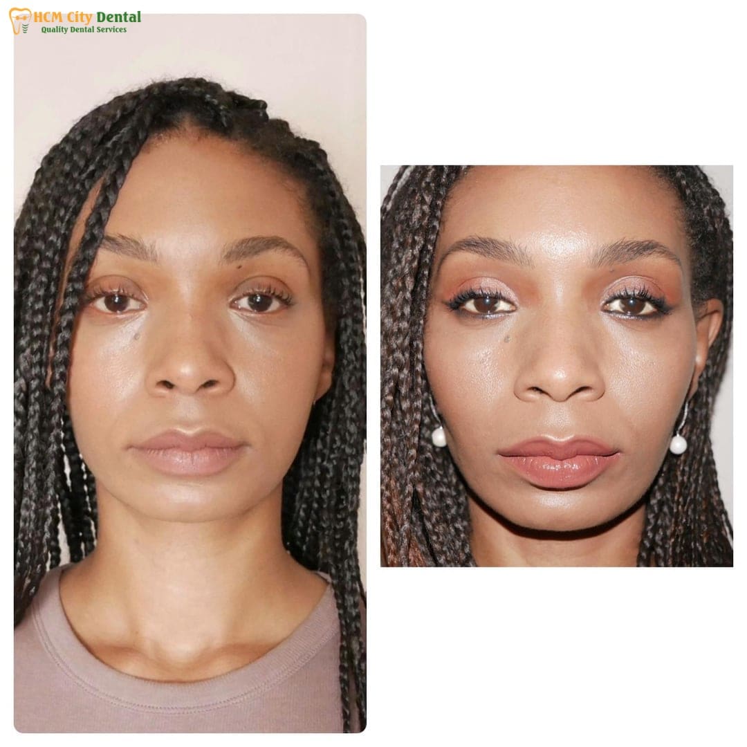 How Braces Change Your Face: Transform Your Smile Today | Dr. Cuong ...