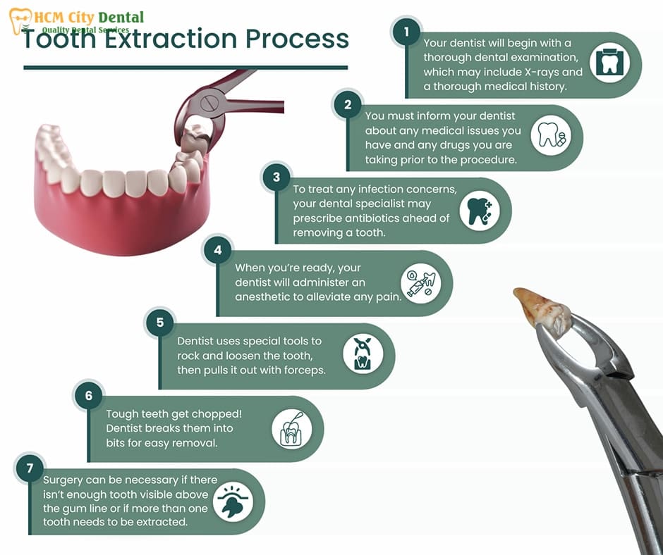 How Do Dentists Pull Teeth? [Full Guide] | Dr. Cuong - Ho Chi Minh City ...