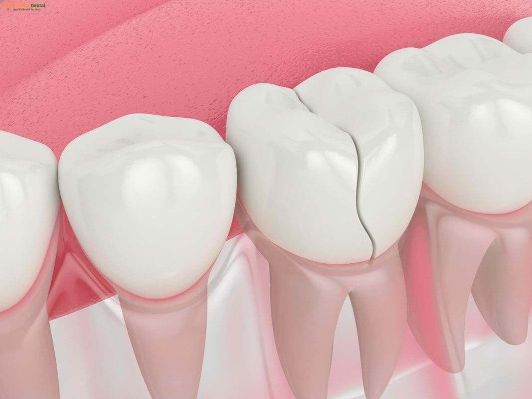 How to Fix a Fractured Tooth Fast – Expert Tips & Remedies | Dr. Cuong ...