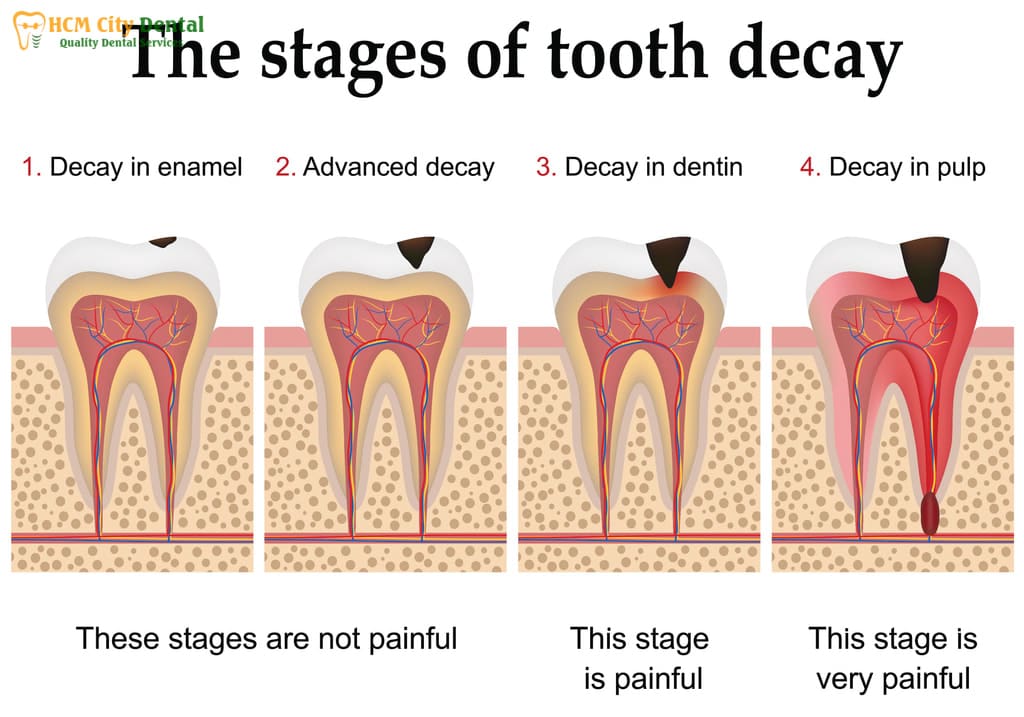 How to Treat Tooth Cavity: Stop Pain & Decay Fast | Dr. Cuong - Ho Chi ...