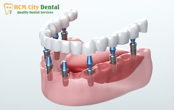 New Technology Teeth Replacement: [Painless?] - Dr. Cuong - Ho Chi Minh ...