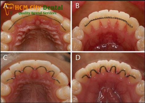 Permanent Retainer After Braces: Keep Your Smile [Lifetime Guide] | Dr ...