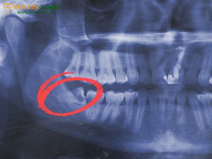 Sideways Wisdom Tooth: Essential Tips for Comfort & Care | Dr. Cuong Ho ...