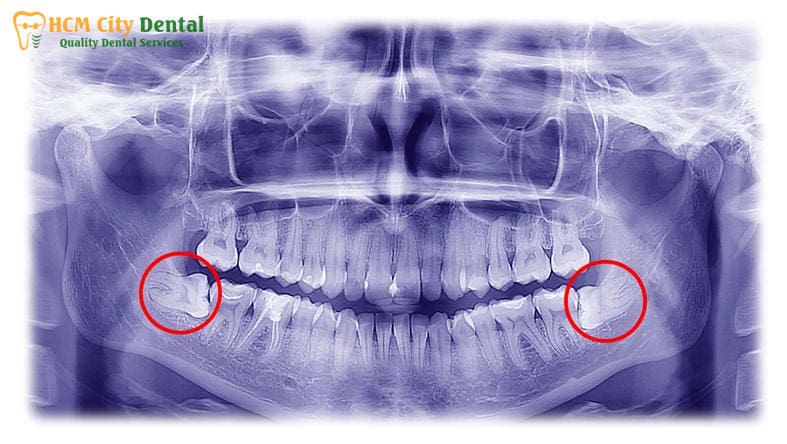 Sideways Wisdom Tooth: Essential Tips for Comfort & Care | Dr. Cuong Ho ...