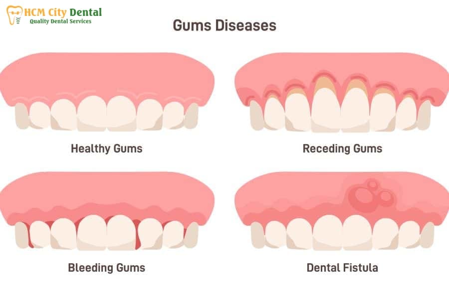 Signs of Receding Gums: 7 [Critical Warning Signs] | Dr. Cuong - Ho Chi ...