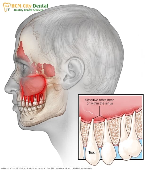 Tooth Sinus Infection? Stop the Pain Now [Tips] | Dr. Cuong - Ho Chi ...