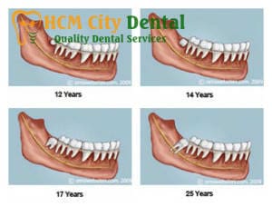 Wisdom Teeth Function: What's Their True Purpose? [Explained] | Dr ...