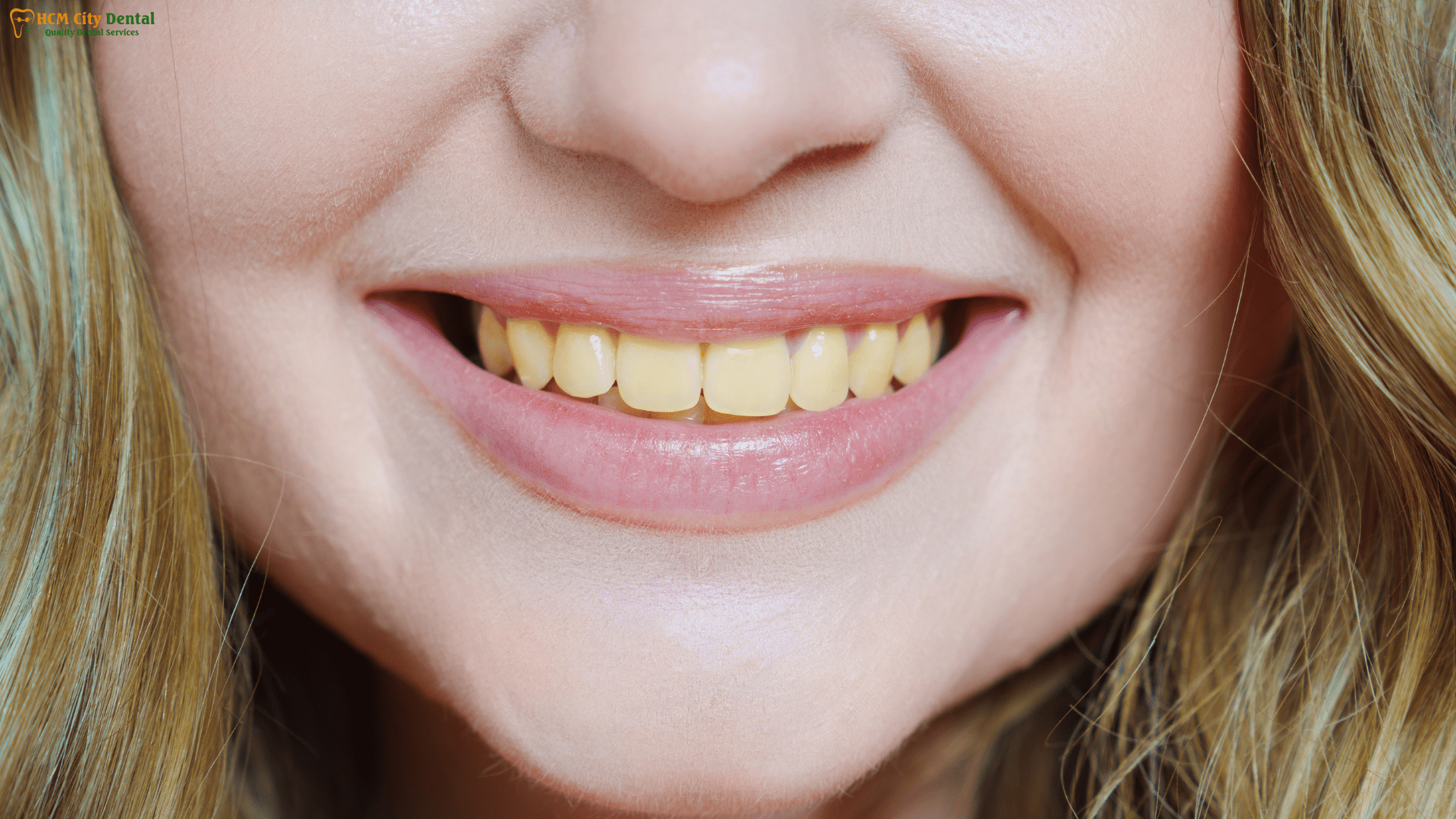 Yellow Teeth? Discover 5 Proven Ways to Whiten Yours! | Dr. Cuong - Ho ...