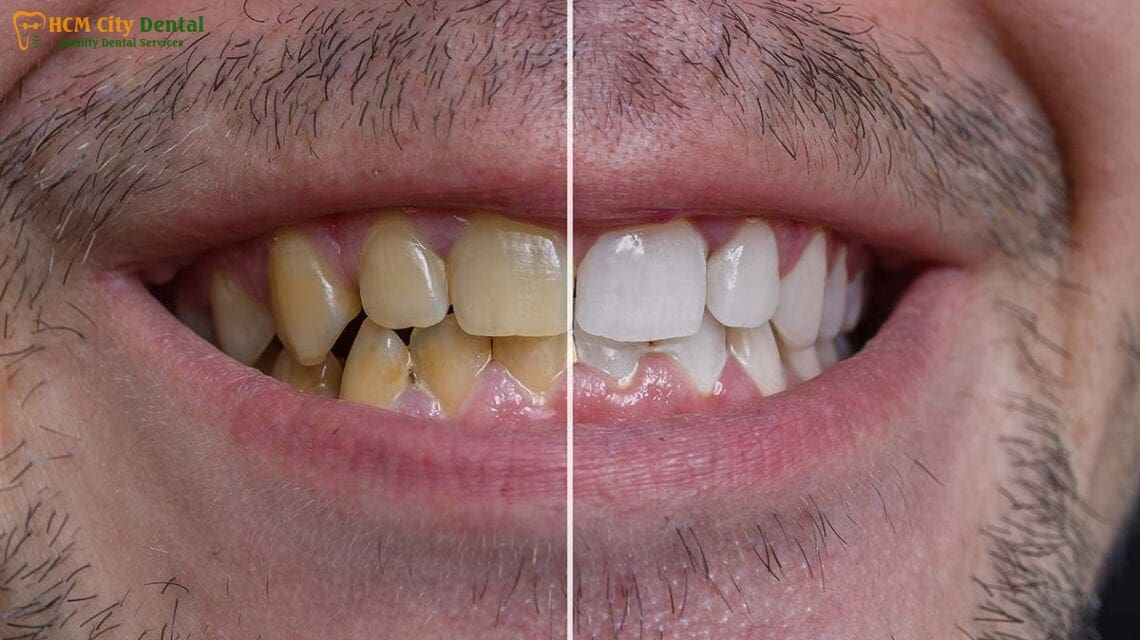 Yellow Teeth? Discover 5 Proven Ways to Whiten Yours! | Dr. Cuong - Ho ...